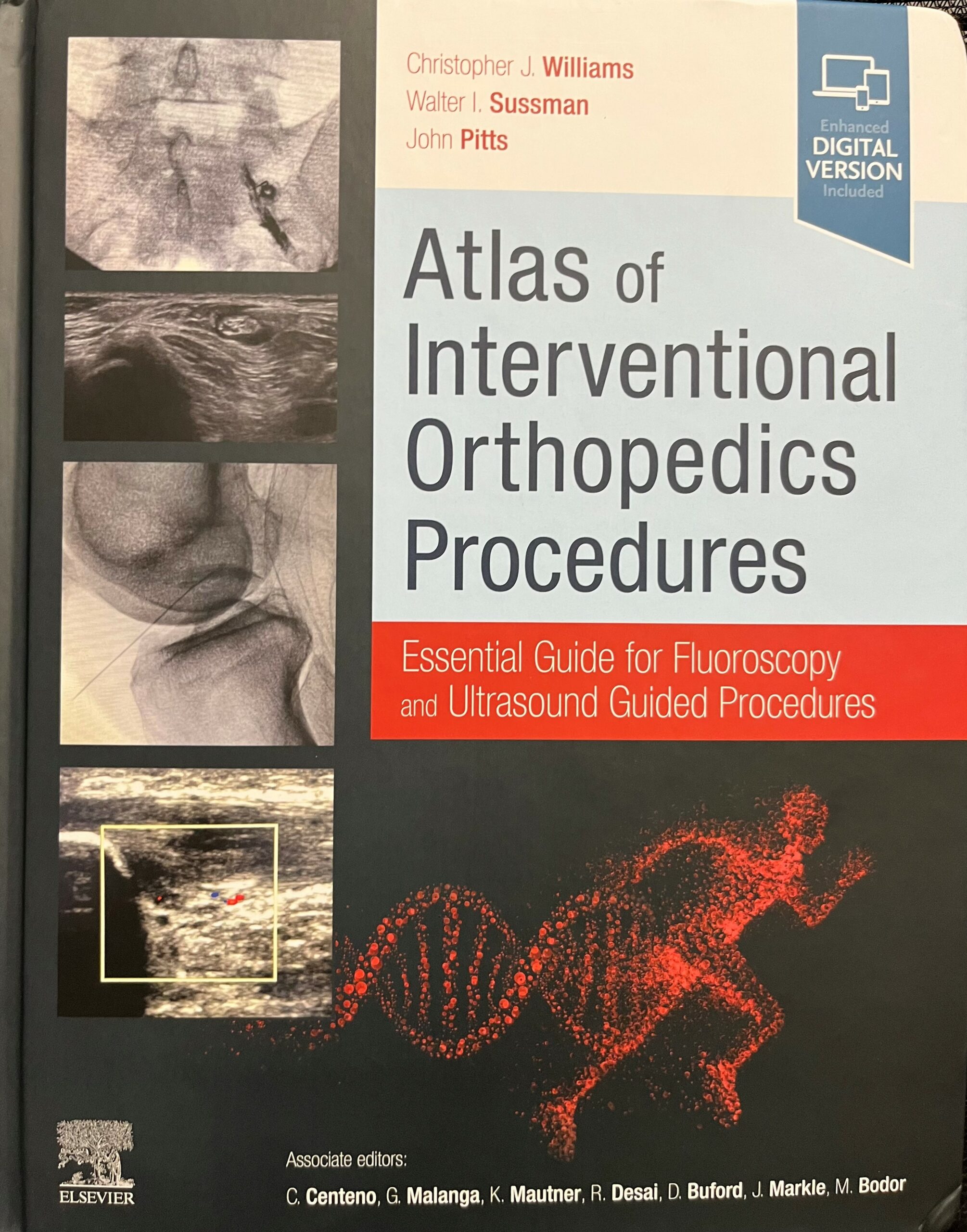 IO Injections of PRP of Bone Marrow Concentrate | Osteoarthritis